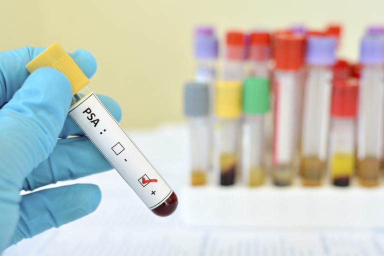 Exame de próstata - conheça novos testes no rastreamento do câncer de ...