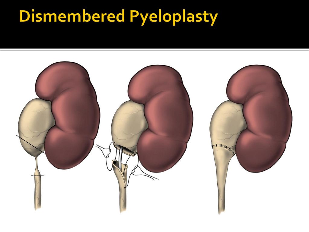 Dismembered Pyeloplasty - Dr. José Alexandre Pedrosa